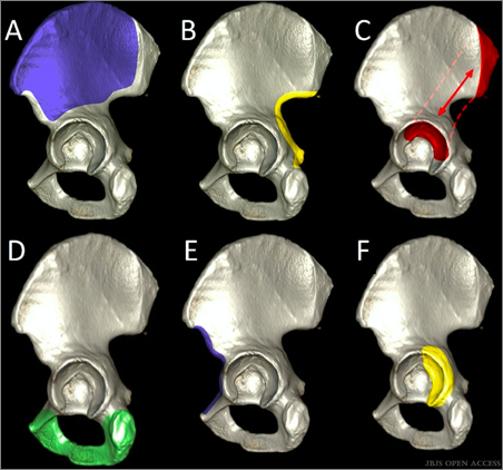 Letournel Classification of Acetabular Fractures – bonesbonesbones
